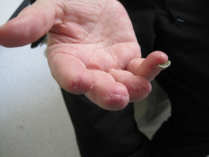 63 Blaue Zehen, blaue Finger - Ärztekammer Nordrhein